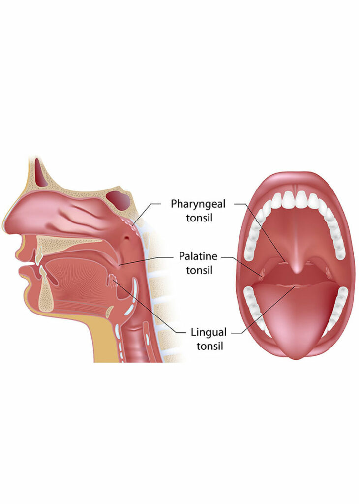 Tonsillectomy Advanced Ent Care