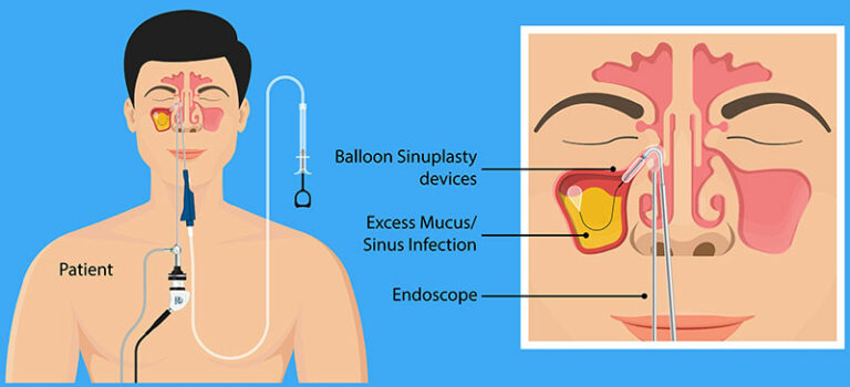 Sinus Surgery – Advanced ENT Care
