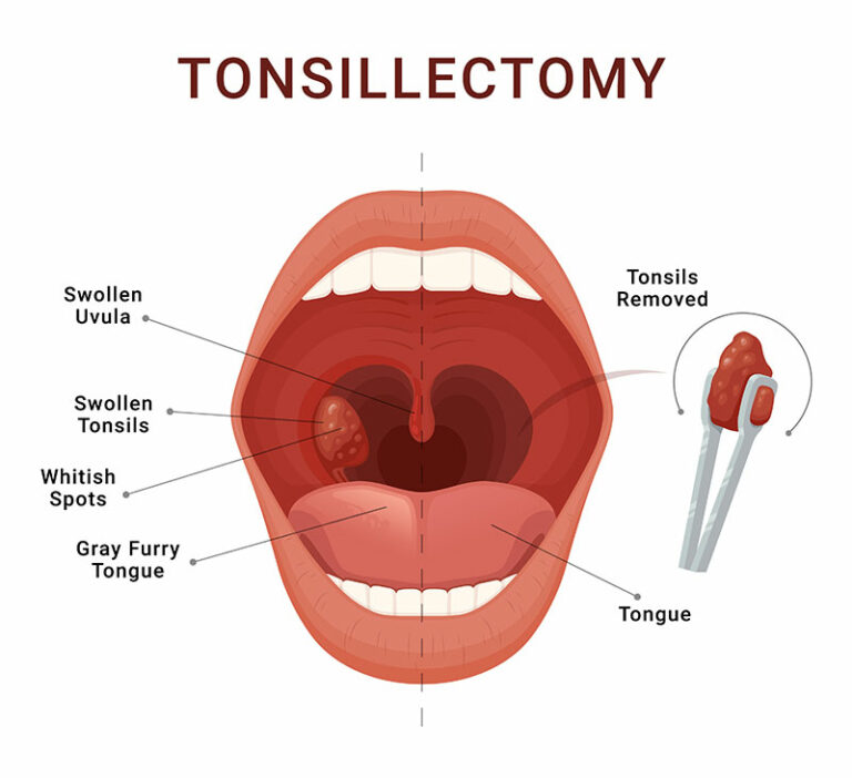 Tonsillectomy – Advanced ENT Care